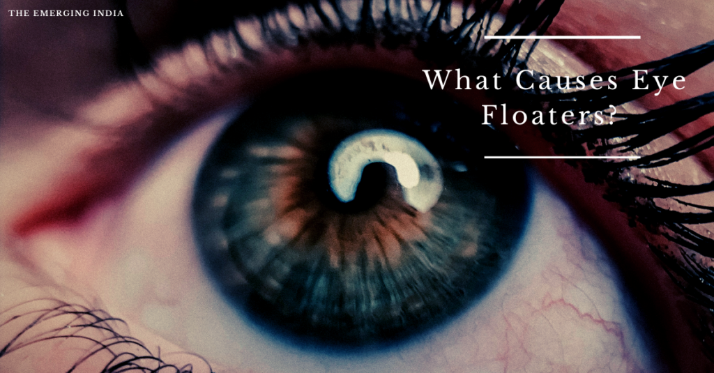 What Causes Eye Floaters? Symptoms, Treatments & Causes