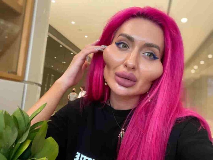 Woman With ‘World’s Biggest Cheeks’ Shares What She Looked Like Before ...