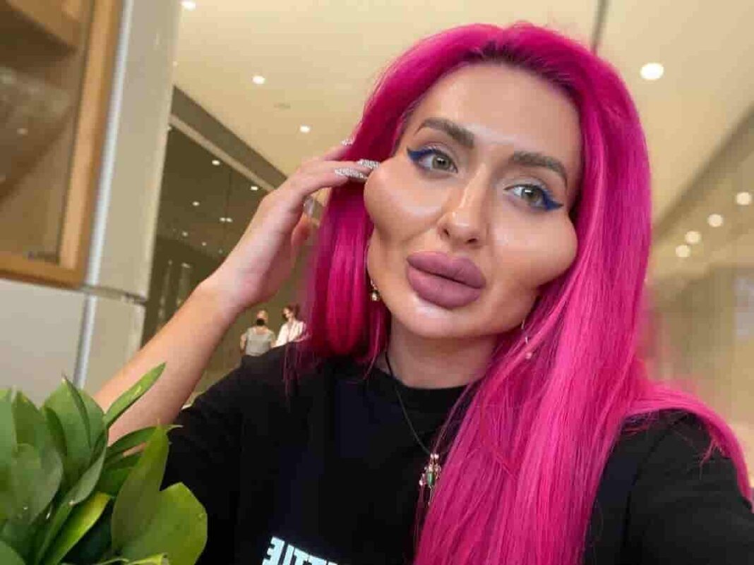 Woman With ‘World’s Biggest Cheeks’ Shares What She Looked Like Before ...