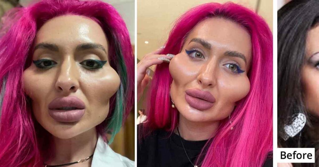Woman With ‘World’s Biggest Cheeks’ Shares What She Looked Like Before ...
