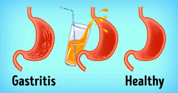 6 Foods to Eat and 7 to Avoid If You’re Suffering From Gastritis
